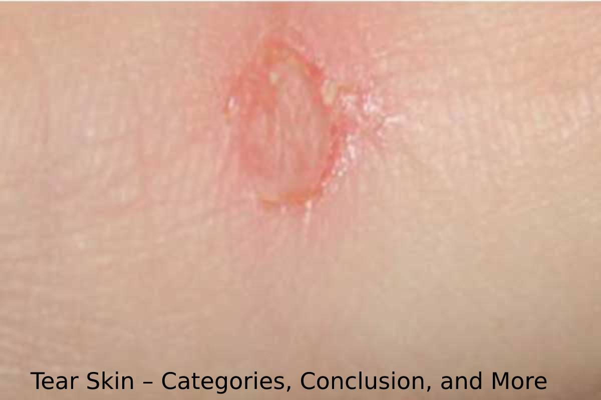 Tear Skin – Categories, Conclusion, and More